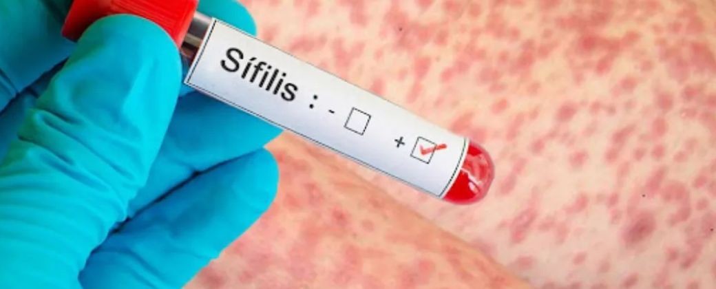 Preocupación por el crecimiento de casos de sífilis: “Era una ...